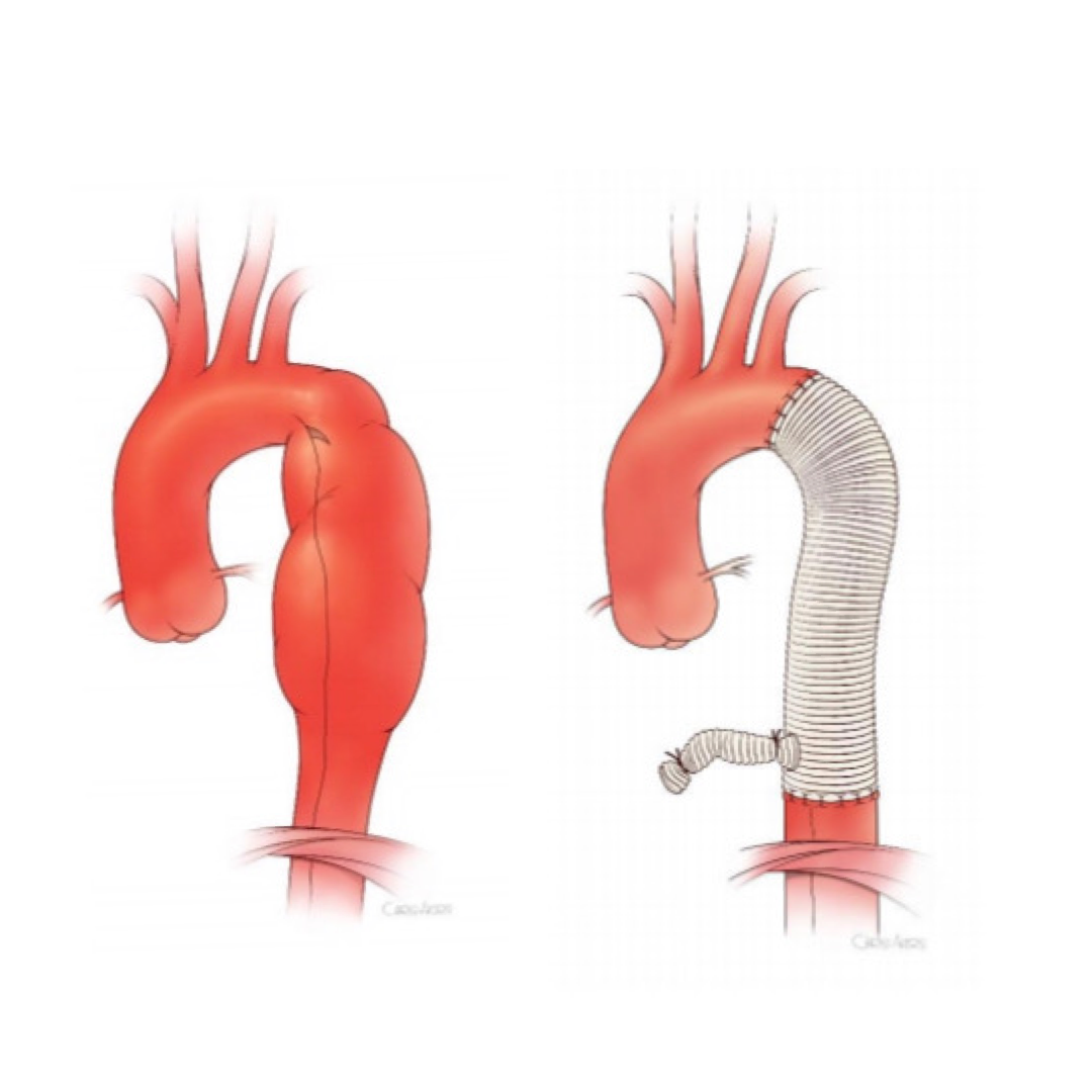 Aortic Aneurysm KaitlenEsmie Aortic Aneurysm KaitlenEsmie