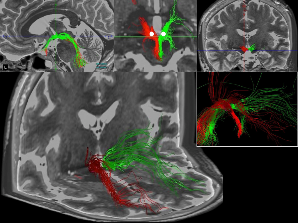Deep Brain Stimulation Program | McGovern Medical School