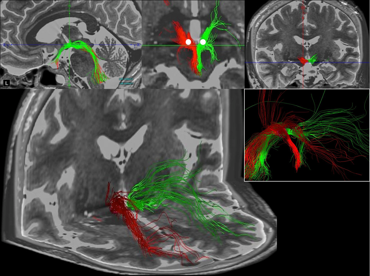 Deep Brain Stimulation Program | McGovern Medical School