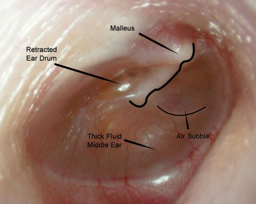 Fluid In The Ear Images McGovern Medical School