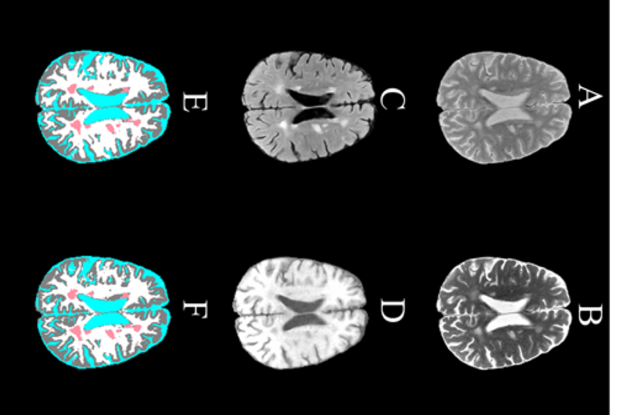 Deep Learning Artificial Intelligence (AI) Applications in MRI ...