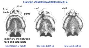 Cleft Lip and Cleft Palate | McGovern Medical School